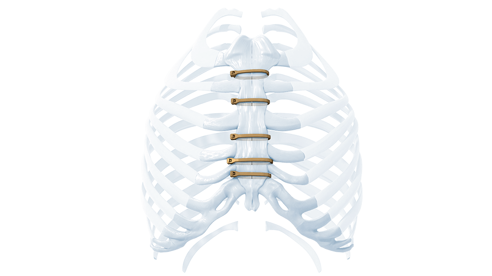 Sternal ZIPFIX™ System | Products| DePuy Synthes