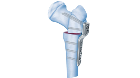 Pediatric LCP Plate System | Products | DePuy Synthes