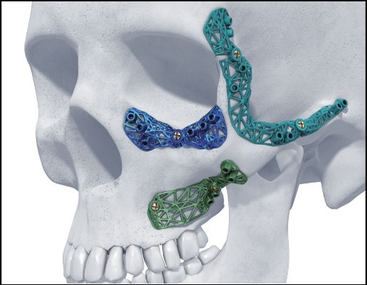 3D-Printed Patient-Specific Surgical Guides | DePuy Synthes