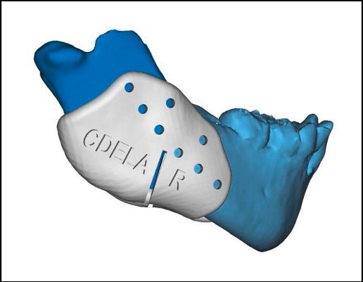 3D-Printed Patient-Specific Surgical Guides | DePuy Synthes
