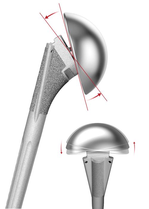 Depuy Synthes Introduces The Inhance Shoulder System – CXXYLX