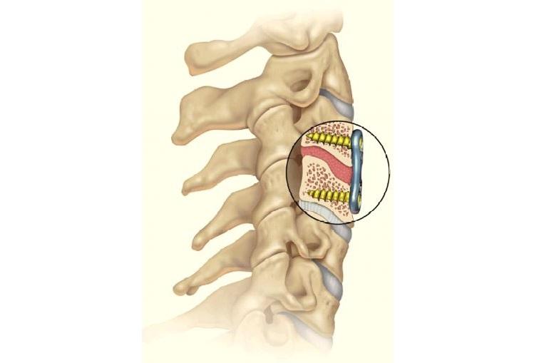 Cervical Fusion | Cervical Spine Fusion | DePuy Synthes
