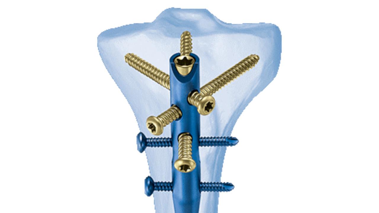 Hip & Knee Fracture | DePuy Synthes