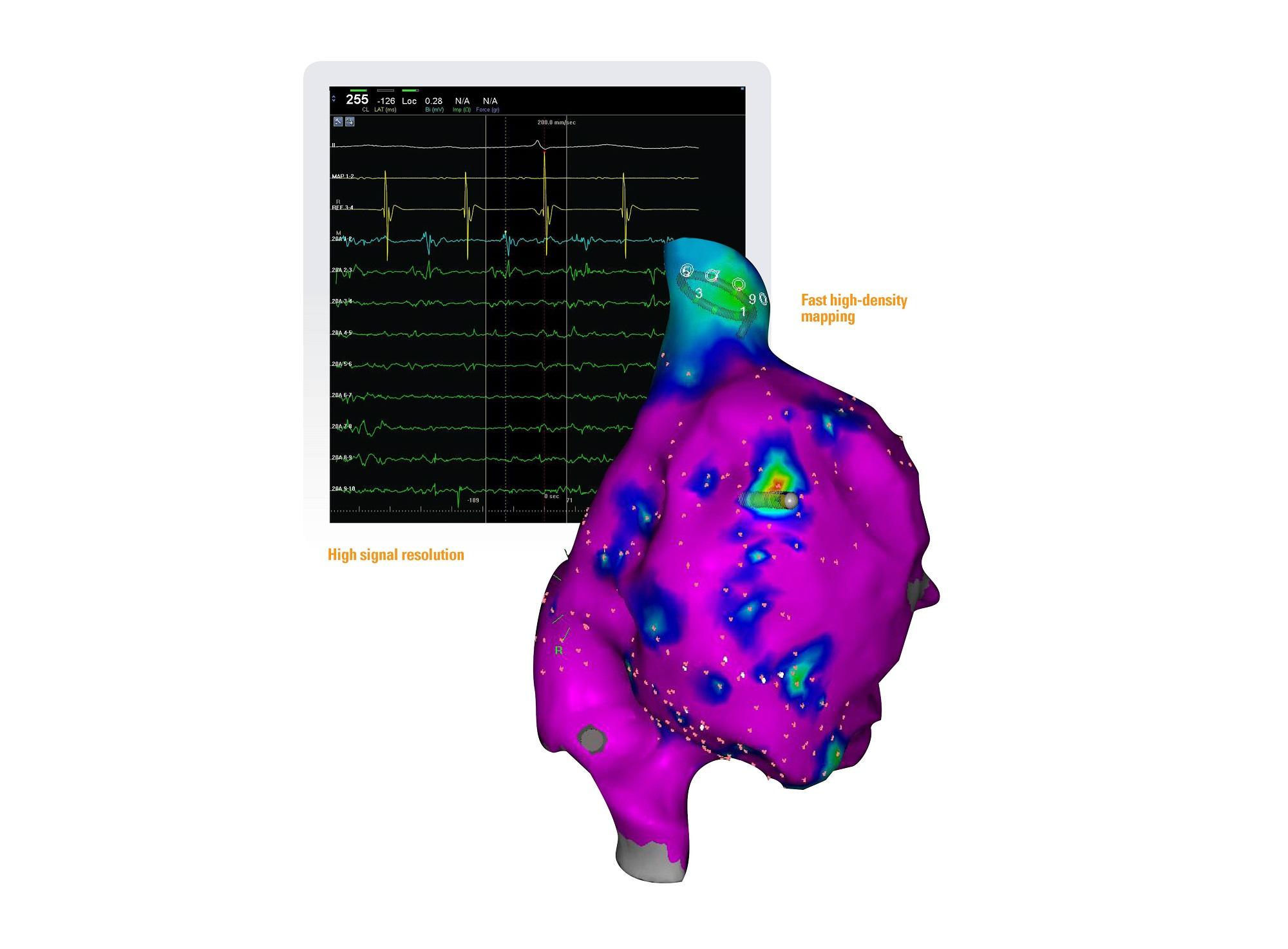 DECANAV® Catheter | Diagnostic Catheter | Biosense Webster | J&J MedTech