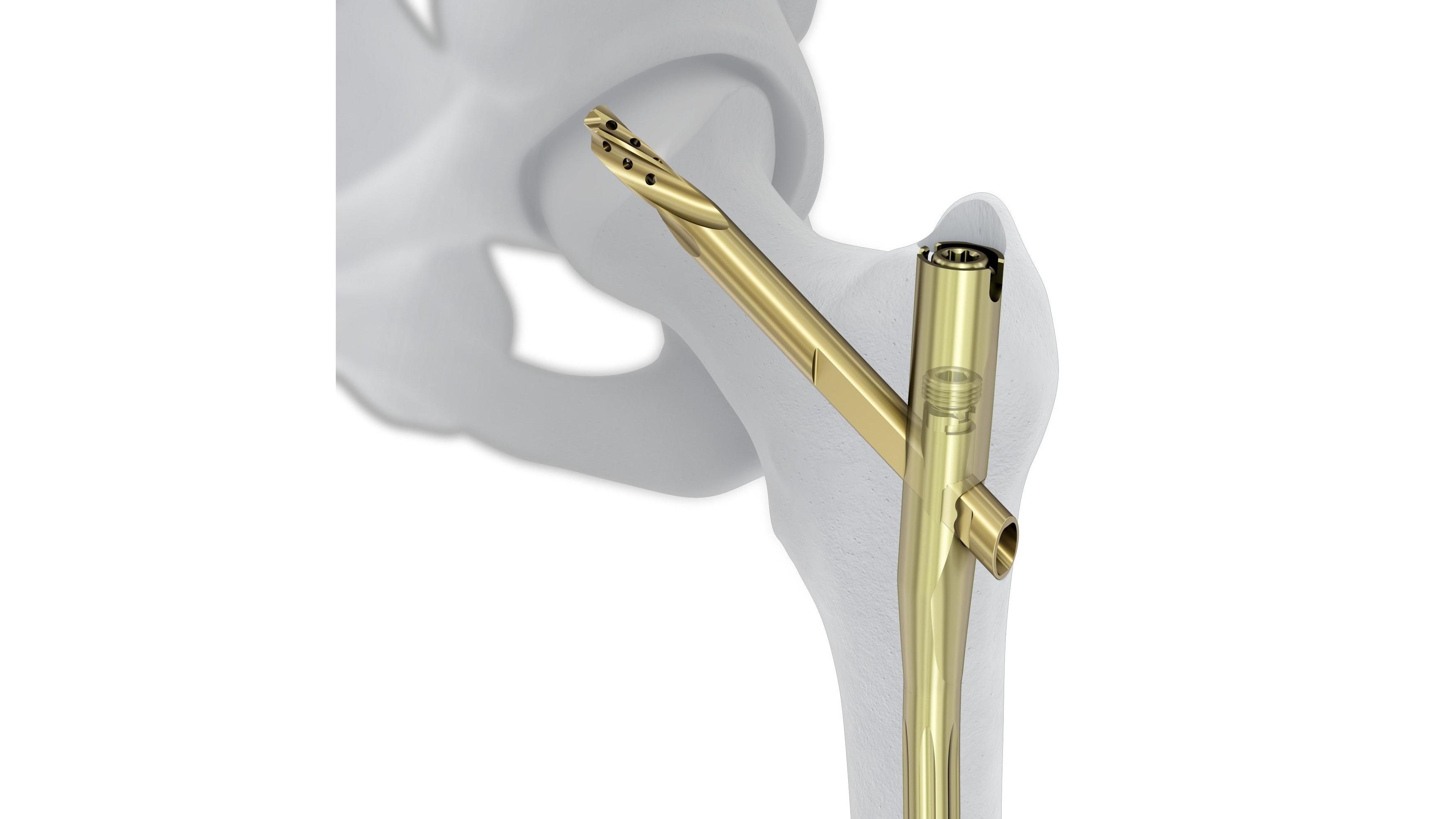 Trauma and Orthopaedic Surgery | DePuy Synthes