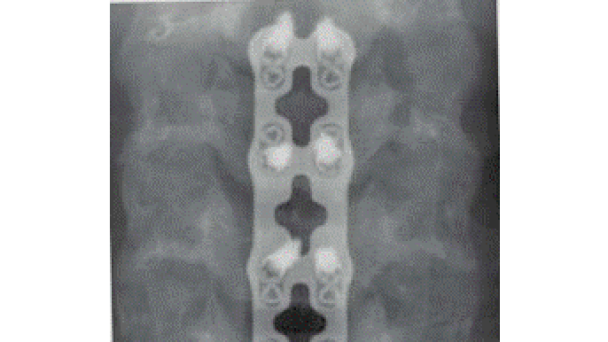 SKYLINE™ Anterior Cervical Plate | DePuy Synthes | J&J MedTech EMEA