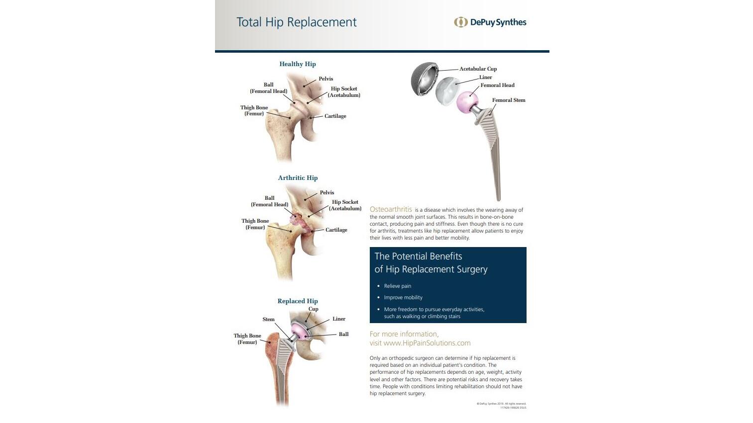 ANTERIOR ADVANTAGE™ Resource Packet | DePuy Synthes