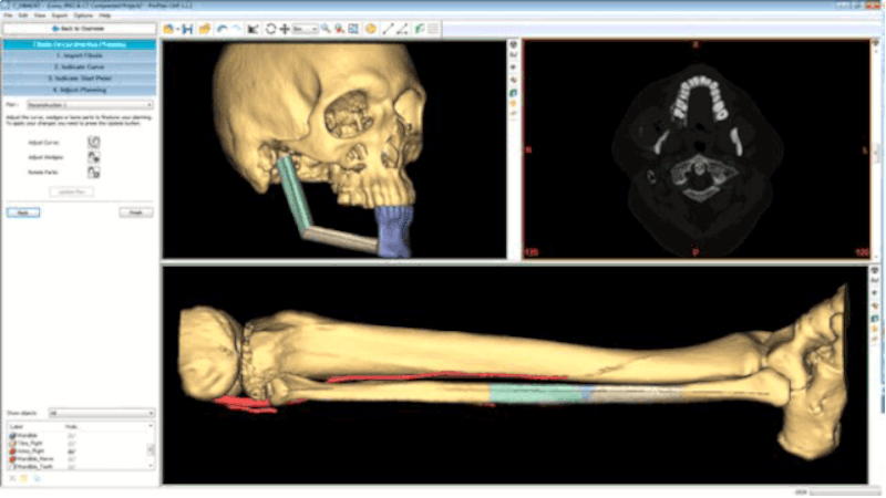 TRUMATCH™ CMF Personalized Solutions | DePuy Synthes