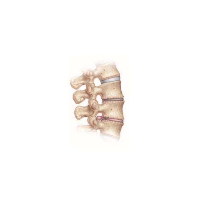 Discectomía cervical anterior con fusión | DePuy Synthes