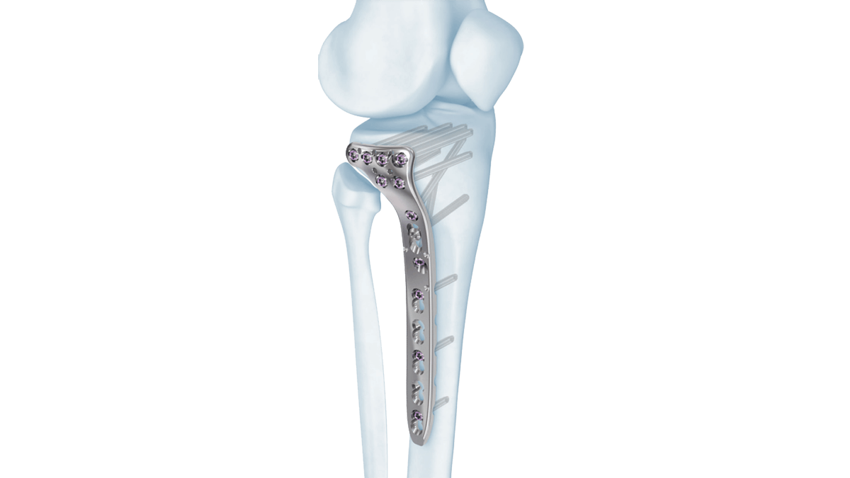Variable Angle LCP™ Proximal Tibia Plate | Products | DePuy Synthes