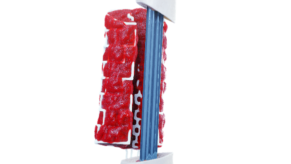 TRUMATCH™ Graft Cage – Long Bone | Products | DePuy Synthes