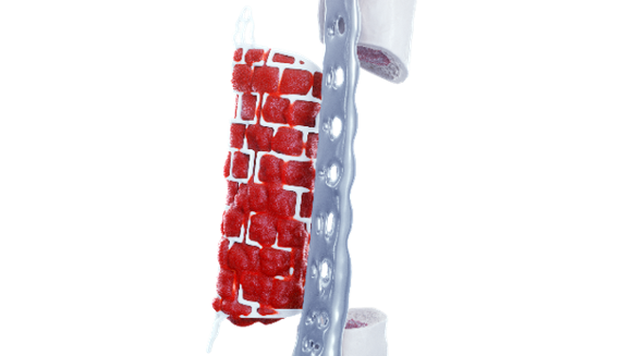 TRUMATCH™ Graft Cage – Long Bone | Products | DePuy Synthes