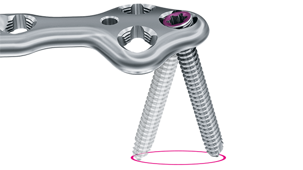 Variable Angle LCP® Foot System | DePuy Synthes | J&J MedTech US