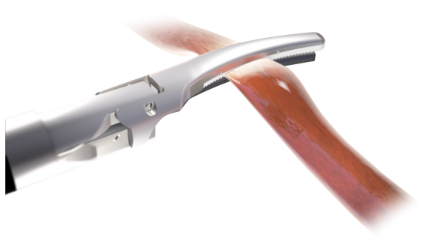 HARMONIC 1100 Shears | Ethicon | J&J MedTech EMEA