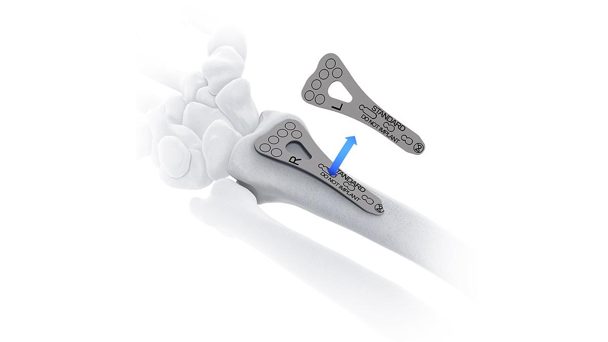 Variable Angle LCP™ Distal Radius Sterile Kit | Products | DePuy Synthes