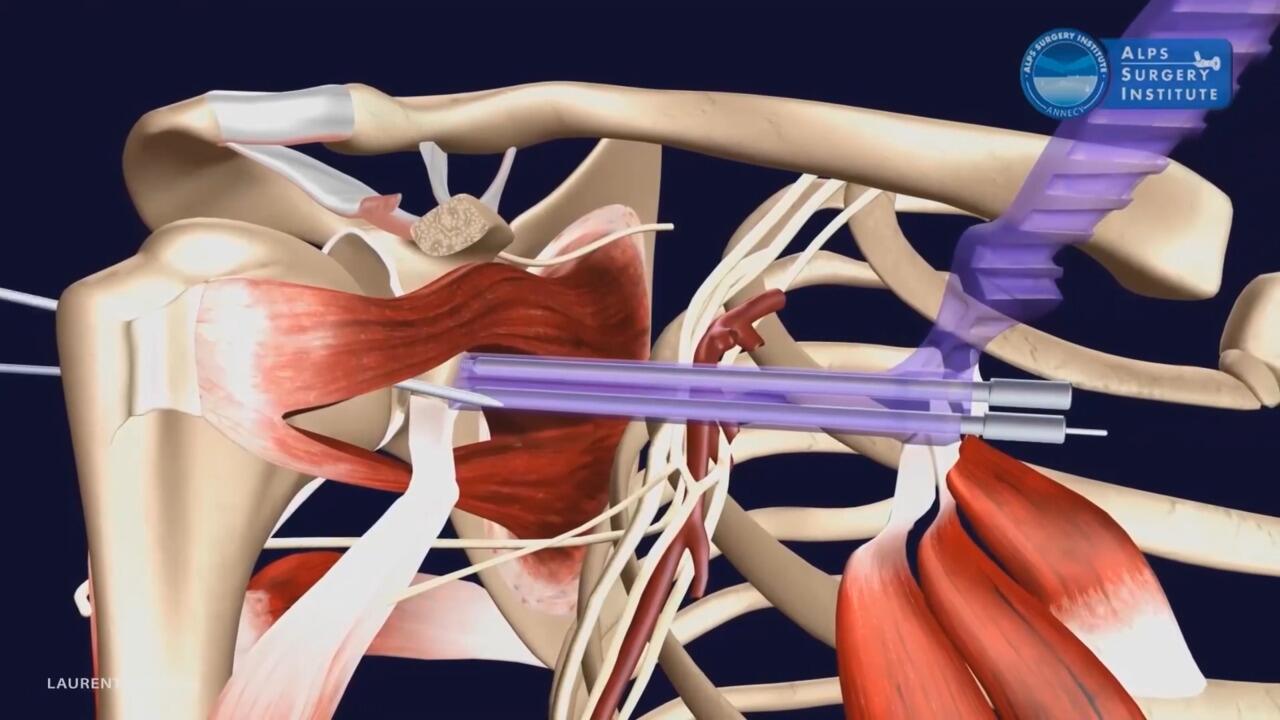 LATARJET EXPERIENCE | Products | DePuy Synthes