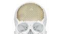 MatrixNEURO™ Preformed Mesh | DePuy Synthes