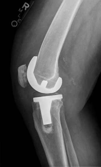 Knee Images | Patient Education Resource | DePuy Synthes